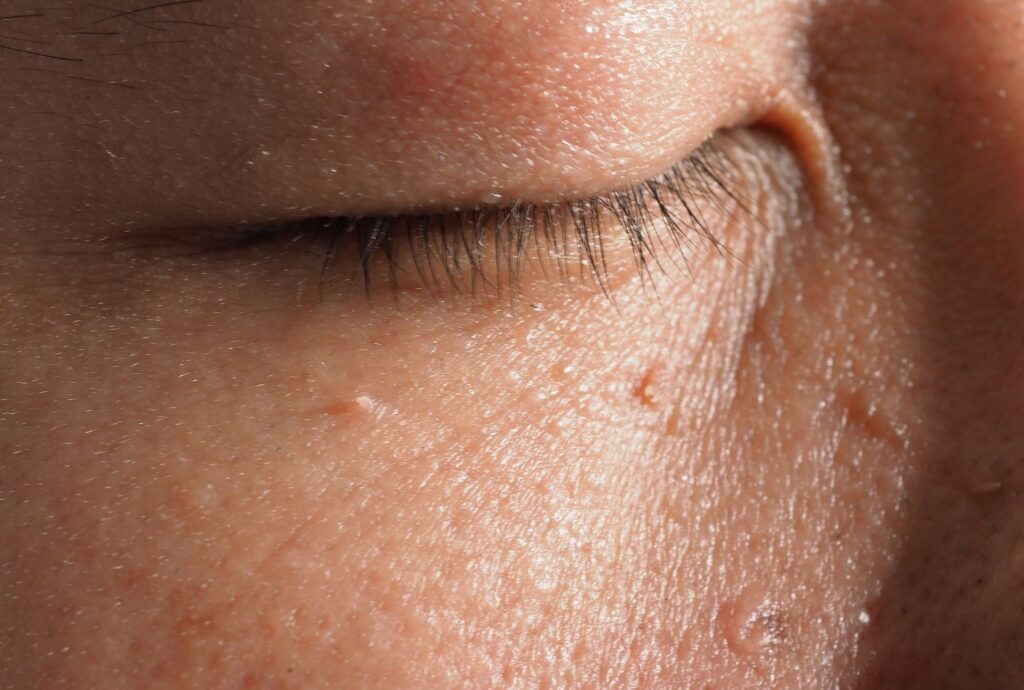 Wart Removal - Hortman Clinics