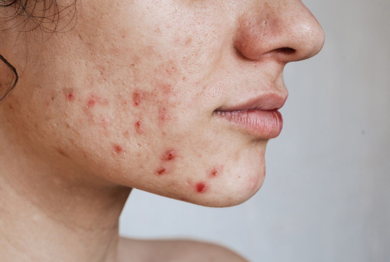 Effective Treatments for Deep Acne Scars: Restore Smooth Skin