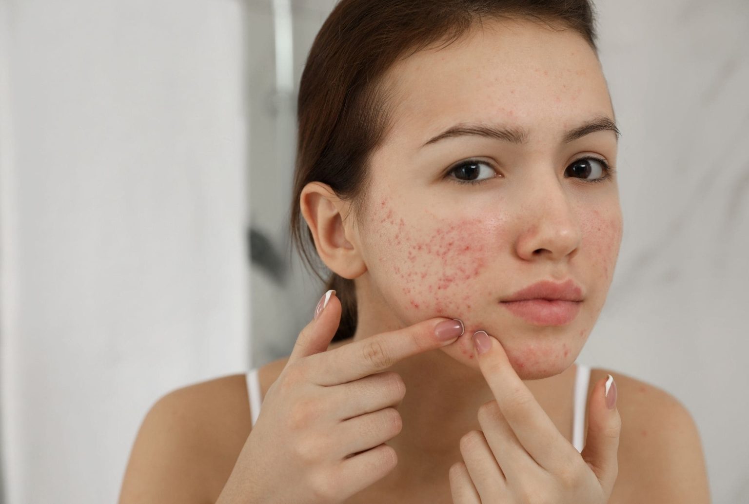 How to Treat Pregnancy Acne Safely | Face Acne During Pregnancy