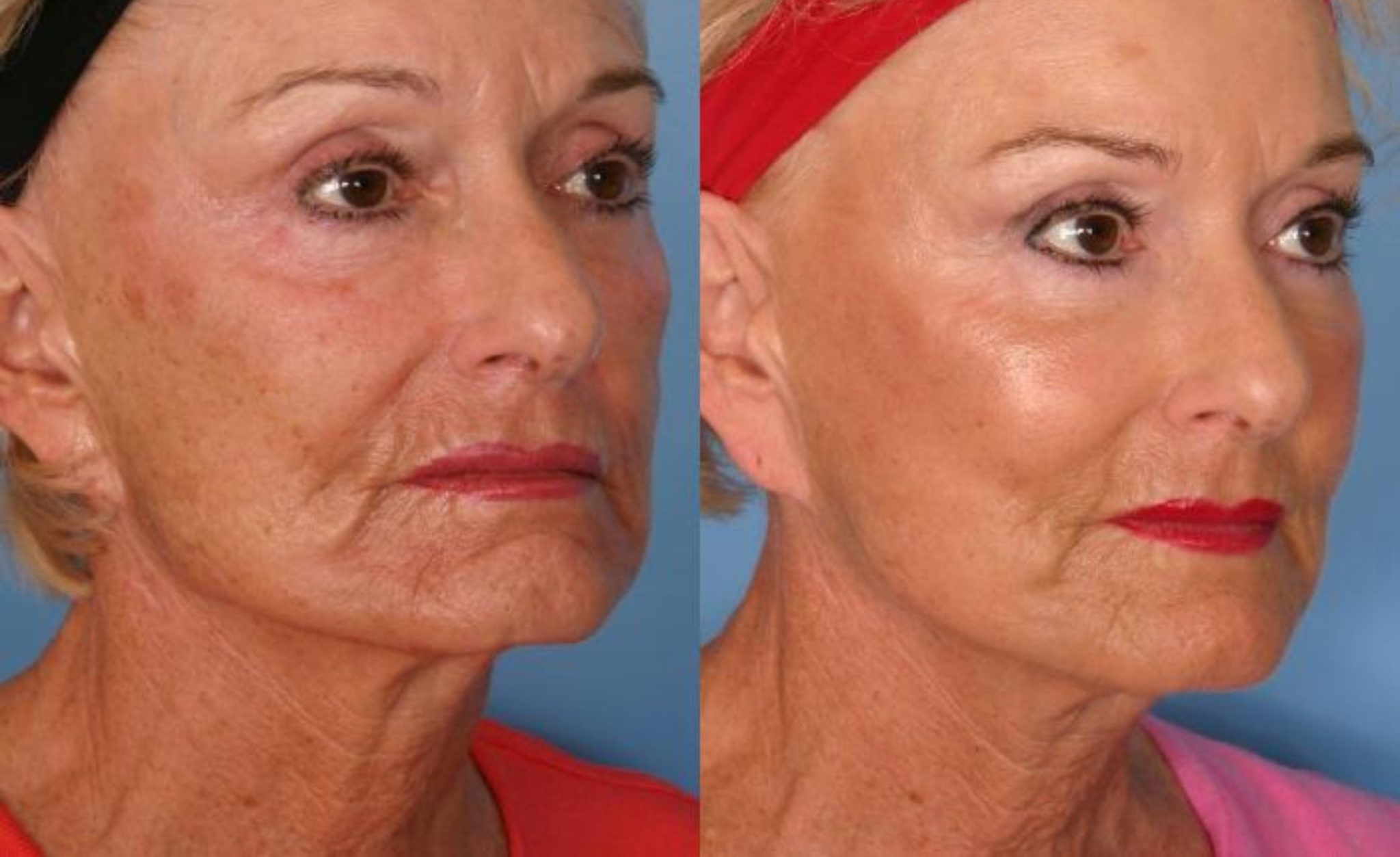Sculptra in Dubai: Cost, Benefits, Before & After, and Where to Get It ...